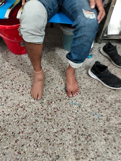 Partial Foot Prosthesis Easy Life For Bangladesh