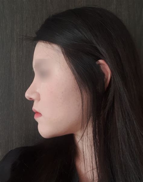 내돈내산 강남 코성형후기8탄 필러 하이코 녹이기 붓기 흉터 복코교정 네이버 블로그