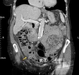 CT Abdomen Coronal View The Appendix Is Dilated To 11 Mm Download Scientific Diagram