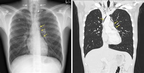 Pneumomediastinum Cxr And Ct Radiology At St Vincents University