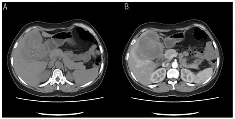 Gallbladder Carcinoma Ultrasound Wk 3 Gallbladder Pathology Gangrenous