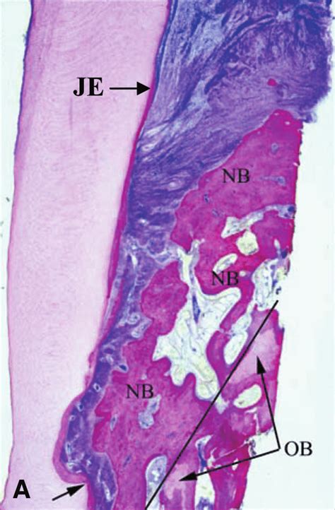 A Histologic Section Of Intrabony Defect Taken 9 Months Following