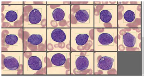 Hematology Case Study 75 Year Old Man With Leukopenia Lablogatory