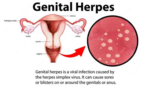 Free Vector Genital Herpes Infographic With Explanation