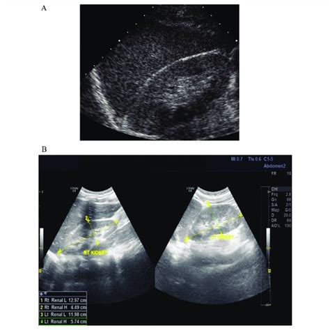 Sonograms Showing Renal Echogenicity Grades 2 A And 3 B Download Scientific Diagram