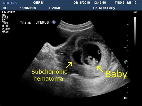 Twinlala Subchorionic Hematoma Placenta Previa And Bedrest Oh My