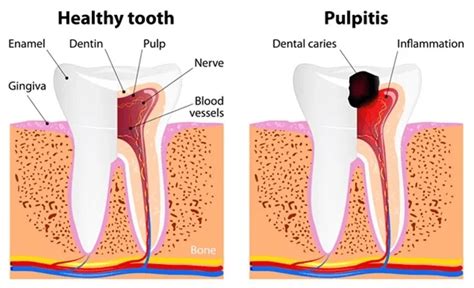 Reversible Pulpitis Treatment Outcomes Of Pulpotomy In Primary Teeth