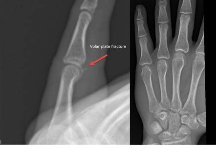 Avulsion Fracture Finger