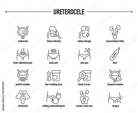 Ureterocele Cid