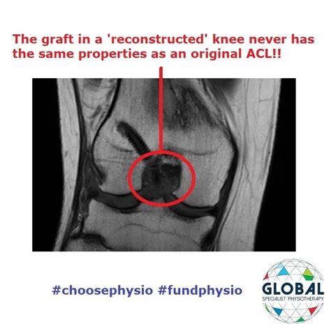 Acl Anterior Cruciate Ligament Non Surgical Management No Surgery