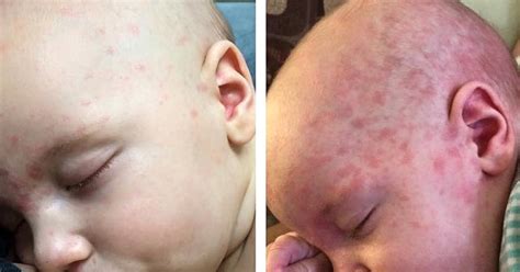 “immunoamnesia” Pneumonia Seizures The Serious Risks Of Measles That
