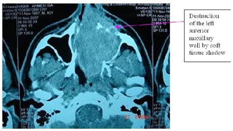 Axial Ct Shows Soft Tissue In The Left Maxillary Sinus Destructing