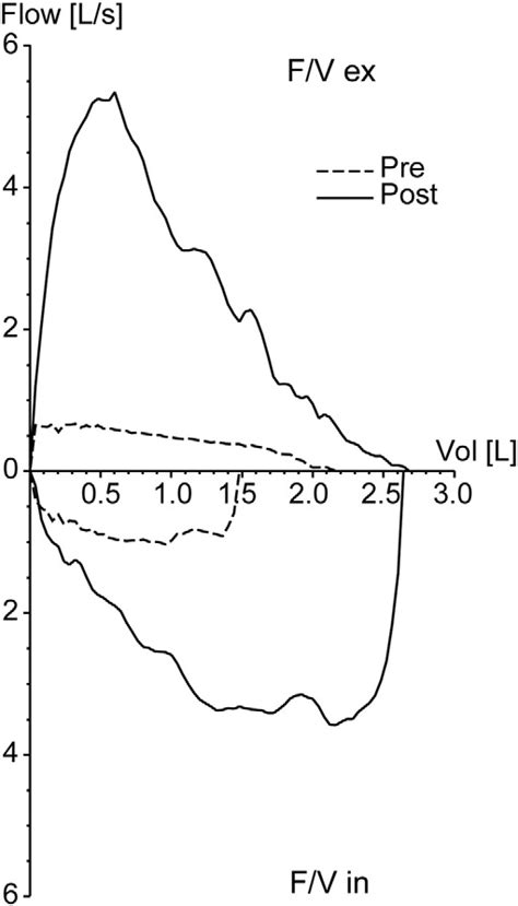 Flow Volume F V Loop Preoperative Dashed Line And Postoperative Download Scientific Diagram