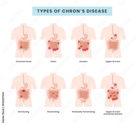 Set Of Different Types Of Crohns Disease Anatomy Classification