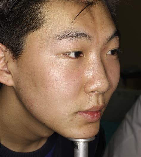 Acne04 3 0 Object Detection Dataset By Umer