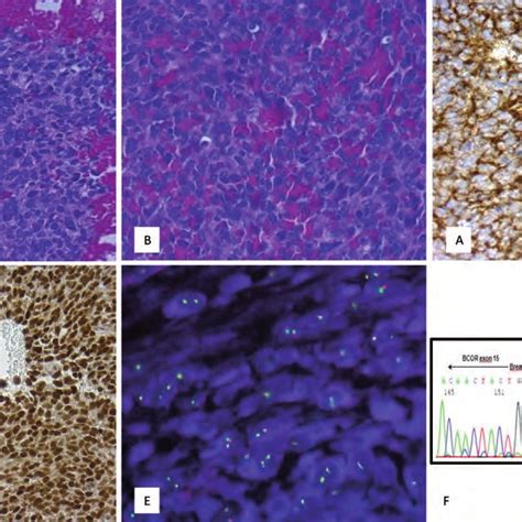 Cic Rearranged Sarcomas With Genetic Confirmation By Rt Pcr A Download Scientific Diagram