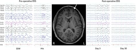 Pre And Post Operative EEG Pre And Post Operative EEG In A