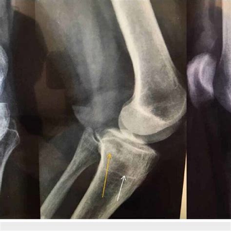 X Rays With Callus Formation Yellow Arrows Implying Fracture Healing Download Scientific