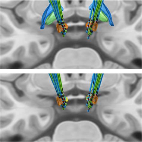 Group Level Reconstruction Of Patients Electrodes As Rendered In Download Scientific Diagram