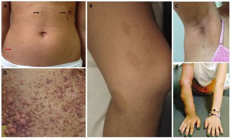 Neurofibromatosis Type 1 Pediatric Aspects And Review Of Genotype