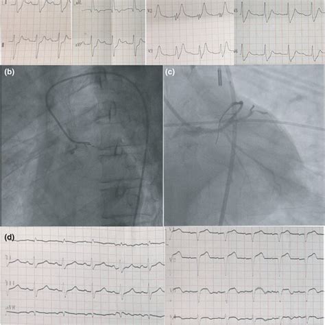 Electrocardiographic Ecg A On Admission Revealed An Upsloping