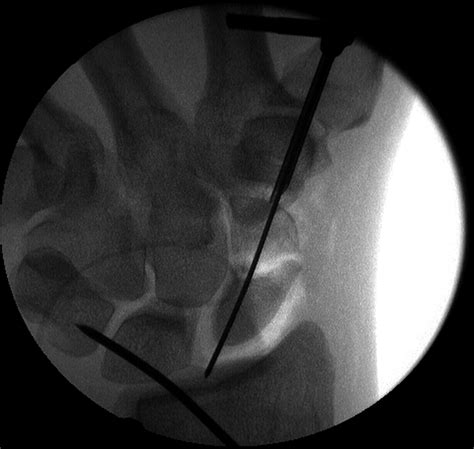 Open Reduction And Internal Fixation Of Scaphoid Fractures