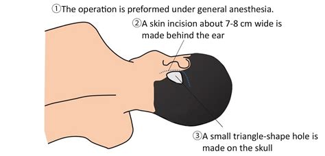 We Provide Innovative Treatments For Trigeminal Neuralgia Ntt Medical