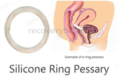 Silicone Ring Pessary Silicone Vaginal Ring Pessary