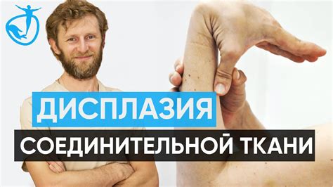 ДИСПЛАЗИЯ СОЕДИНИТЕЛЬНОЙ ТКАНИ симптомы и лечение Youtube