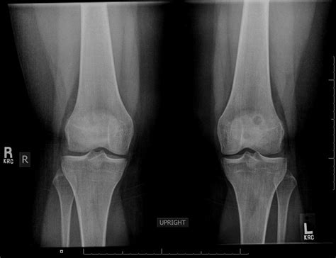Dorsal Defect Of The Patella Radiology Case