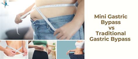 Mini Gastric Bypass Vs Traditional Gastric Bypass Which Is Best For Weight Loss In Turkey