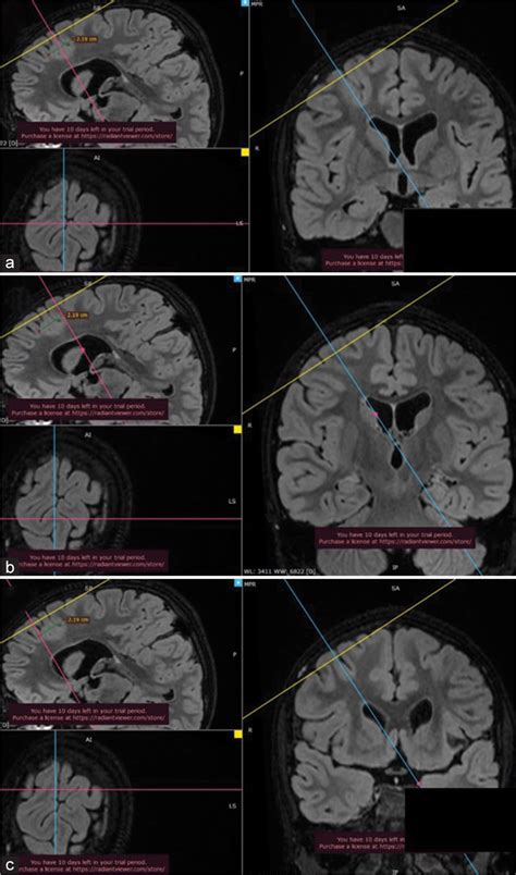 Use Of Cost Effective Software For Lesion Localization In Brain Surgery Technical Note