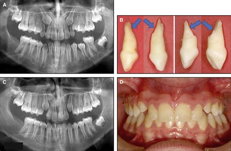 Cuspid Teeth Impaction At Esther Parr Blog