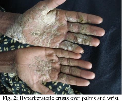 Crusted Scabies Hands