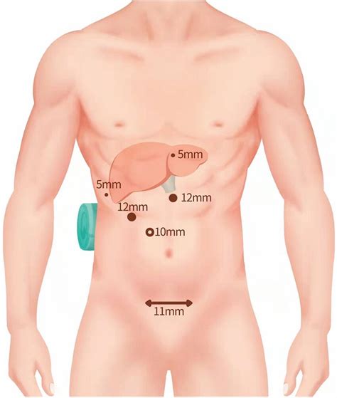 The Trocar Layout For Right Hemihepatectomy Via Caudal Approach The Download Scientific