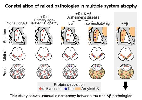 Mixed Pathology Variant Of Multiple System Atrophy Highlights Novel Concept To Interpret Co