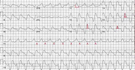 Ecg Case 174 Hyperkalemia Sine Wave Pattern Manual Of Medicine