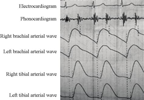 Simultaneous Recordings Of The Electrocardiogram Phonocardiogram And