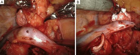 Radical Lymphadenectomy Of Right Paratracheal 4r Node Station A