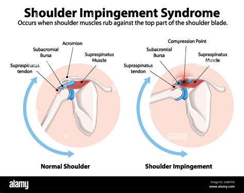 Comparison Of Normal Shoulder And Impingement Stock Vector Image And Art