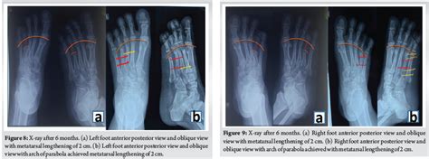 A Modified Deformity Correction Method For Congenital Brachymetatarsia