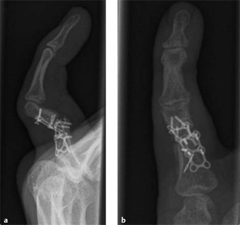 Extra Articular Fractures Of The Phalanges Musculoskeletal Key