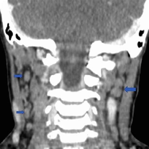 A High Power View Hematoxylin And Eosin X400 Of The Cervical Lymph Download Scientific