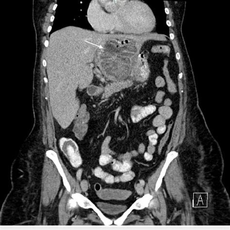 Ct Scan Of The Abdomen With Intravenous Contrast Shows A Liver Abscess