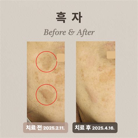 60대 여성 흑자 제거 Part1 치료 후기기미 치료중 강남 대치동 한티 피부과 전문의 루미인피부과