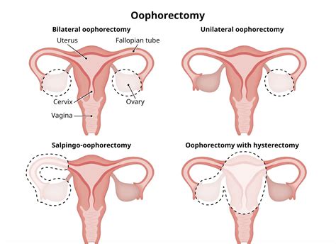 What Is An Oophorectomy My Health And Fitness