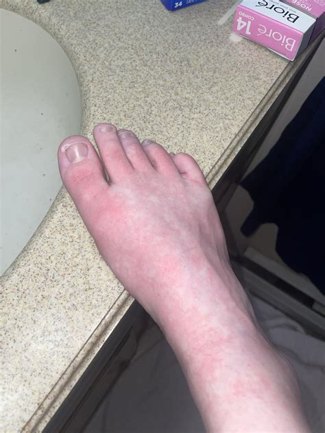 Is This Caused By Raynauds Rraynauds