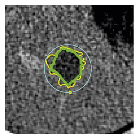 Tumor Segmentation Using The Proposed Method DRLS With Two Different