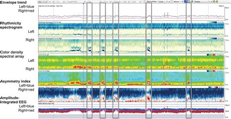 Example Of A 1 Hour Quantitative Eeg Qeeg Panel Without Automated