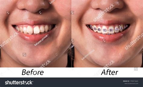 Orthodontic Braces Before And After 1 739 Before After Orthodontic